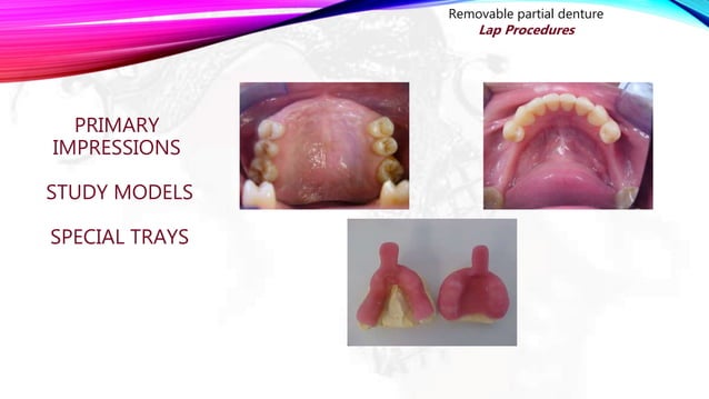 Lab steps of partial denture framework construction | PPTX