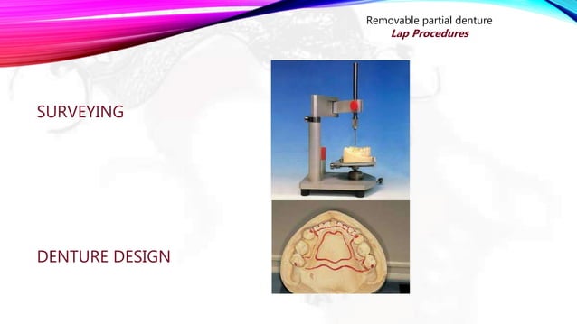 Lab steps of partial denture framework construction | PPTX