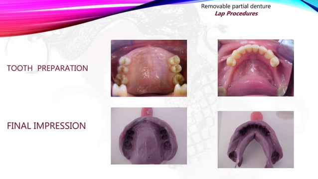 Lab steps of partial denture framework construction | PPTX