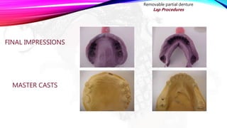 Lab steps of partial denture framework construction | PPTX