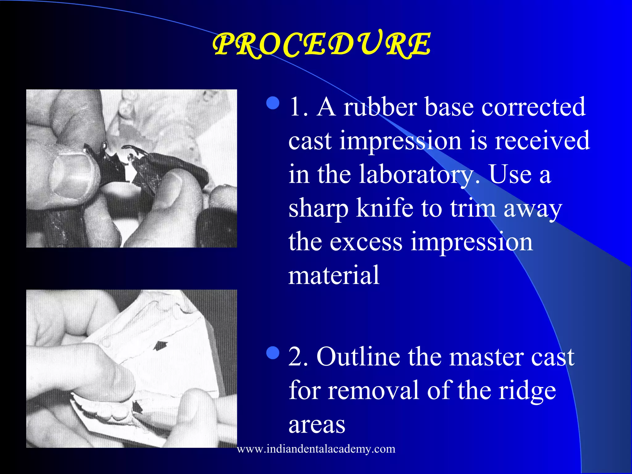 Lab procedures in conventional cast partial dentures / dental lab ...