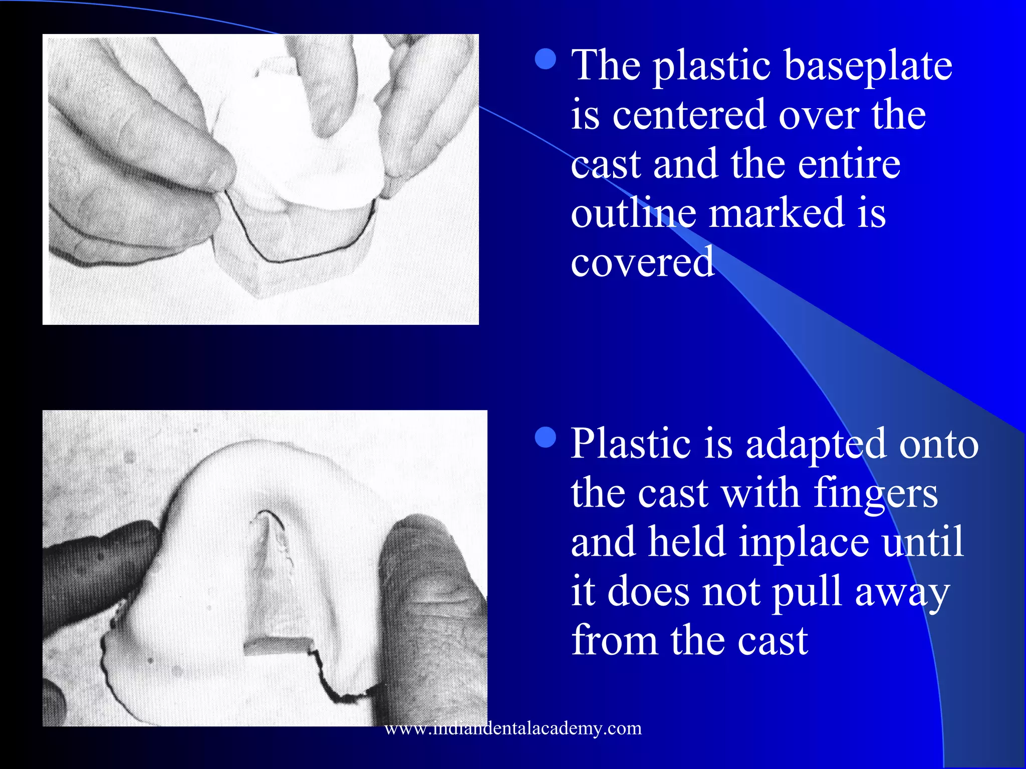 Lab procedures in cast partial dentures / dental lab courses | PPT