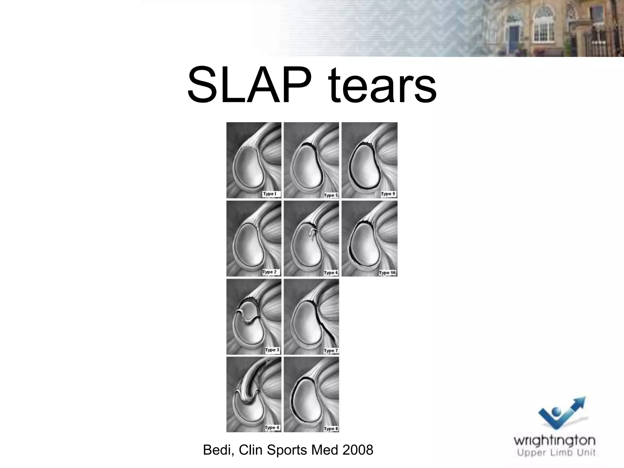 Labral injuries and traumatic instability | PPT