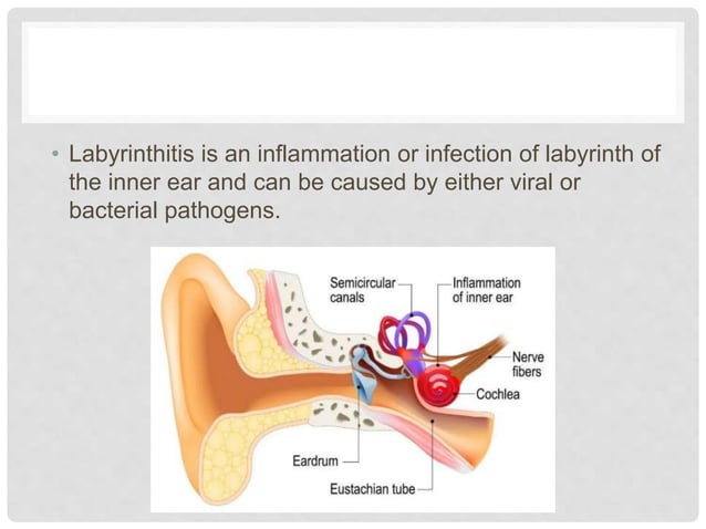Labrinthitis