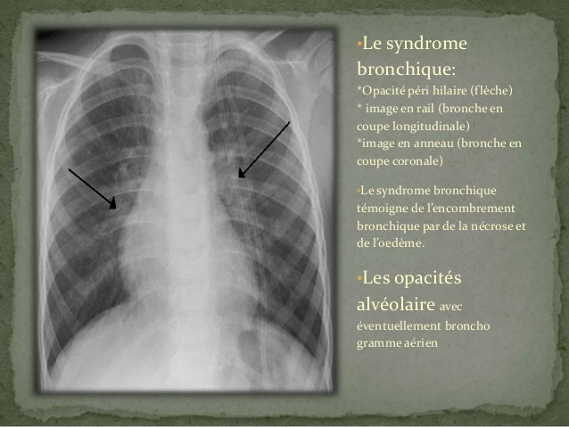 La bronchiolite aigue