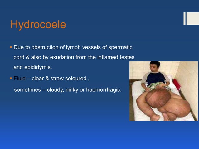Wuchereria bancrofti - Filariasis | PPTX | Infectious Diseases ...