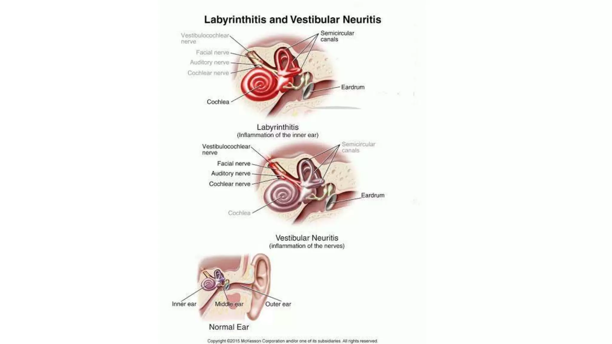Labyrinthitis.pptx | Ear, Nose and Throat Conditions | Diseases and ...