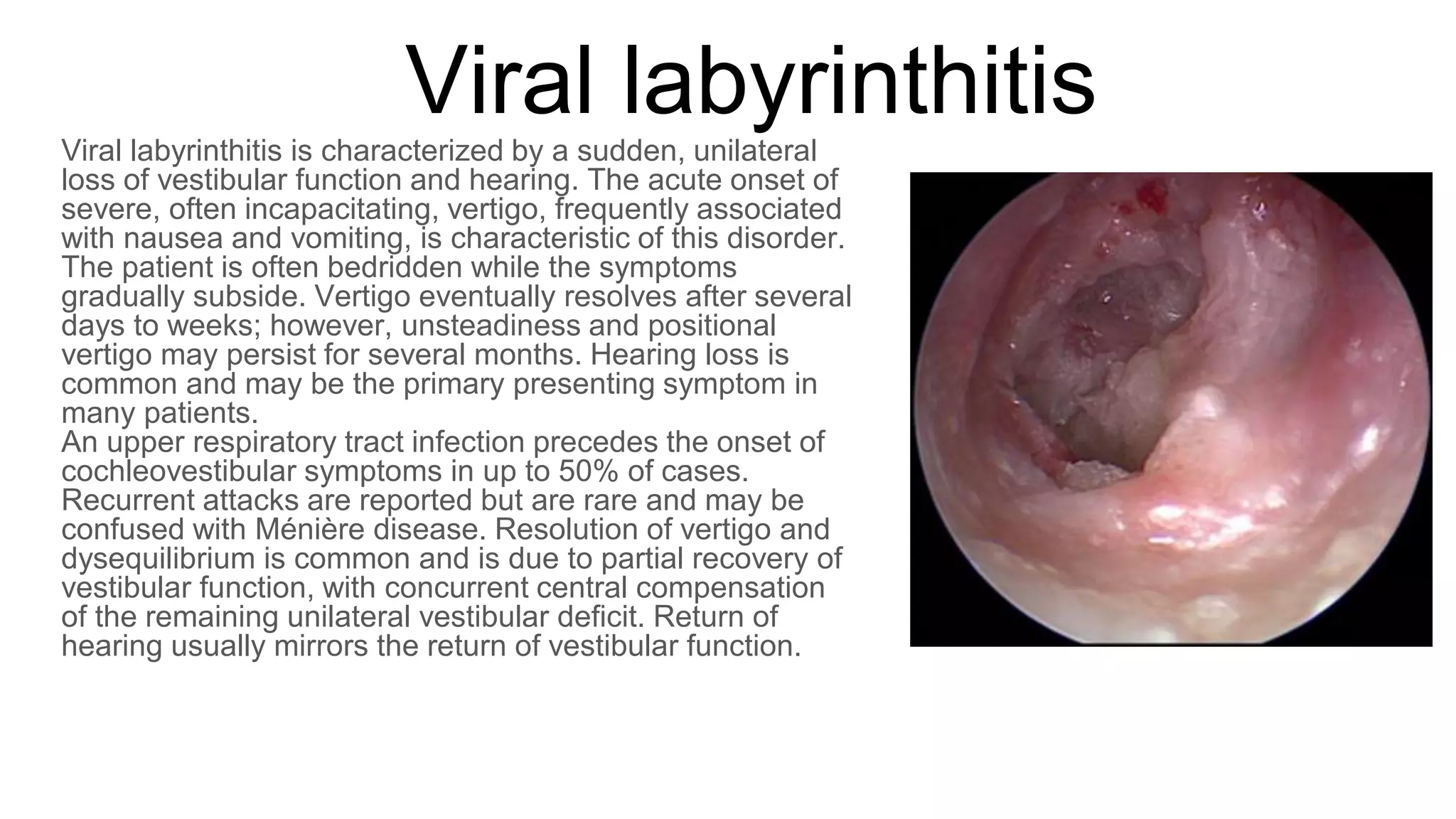 Labyrinthitis.pptx