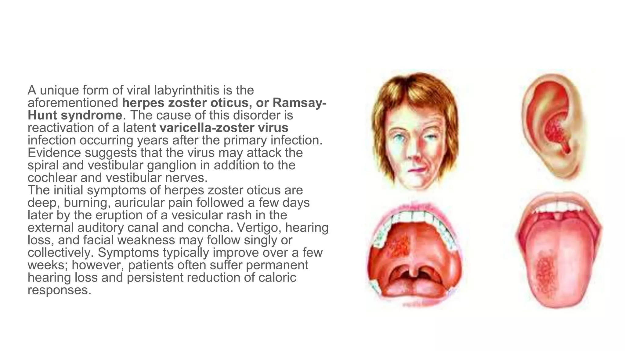 Labyrinthitis.pptx