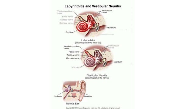 Labyrinthitis.pptx | Ear, Nose and Throat Conditions | Diseases and ...