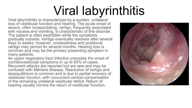 Labyrinthitis.pptx | Ear, Nose and Throat Conditions | Diseases and ...
