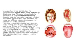 Labyrinthitis.pptx