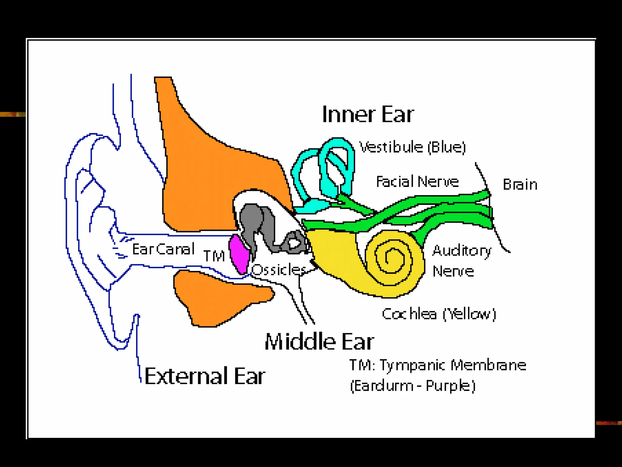 LABYRINTHITIS ,ITS CAUSES ,ETIOLOGY, SIGNS AND SYMPTOMS ,COMPLICATIONS ...