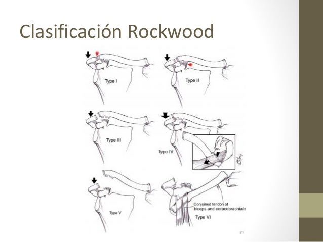 Luxación acromioclavicular