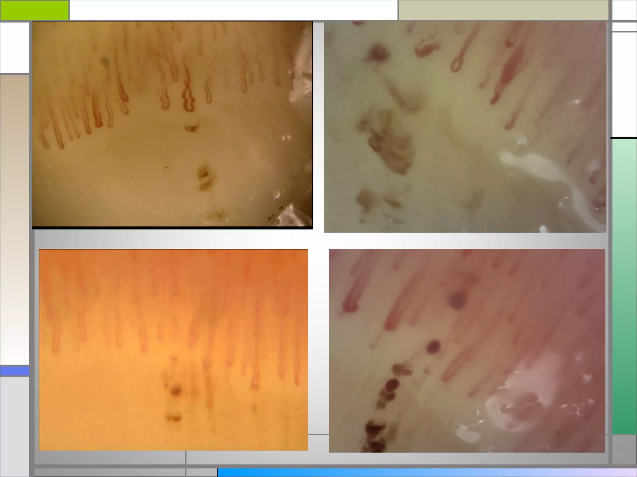 La capillaroscopia nell'artrite reumatoide | PPT