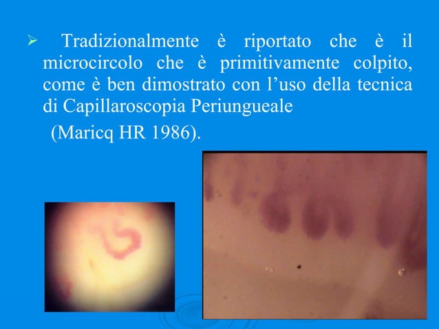 La capillaroscopia può fare la differenza nella diagnosi precoce | PPT