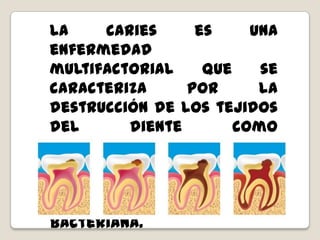 La caries p.p. | PPTX
