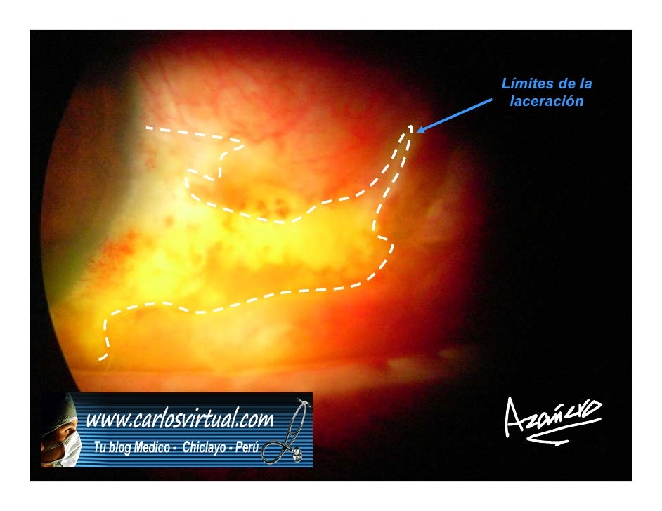 Laceracion de conjuntiva