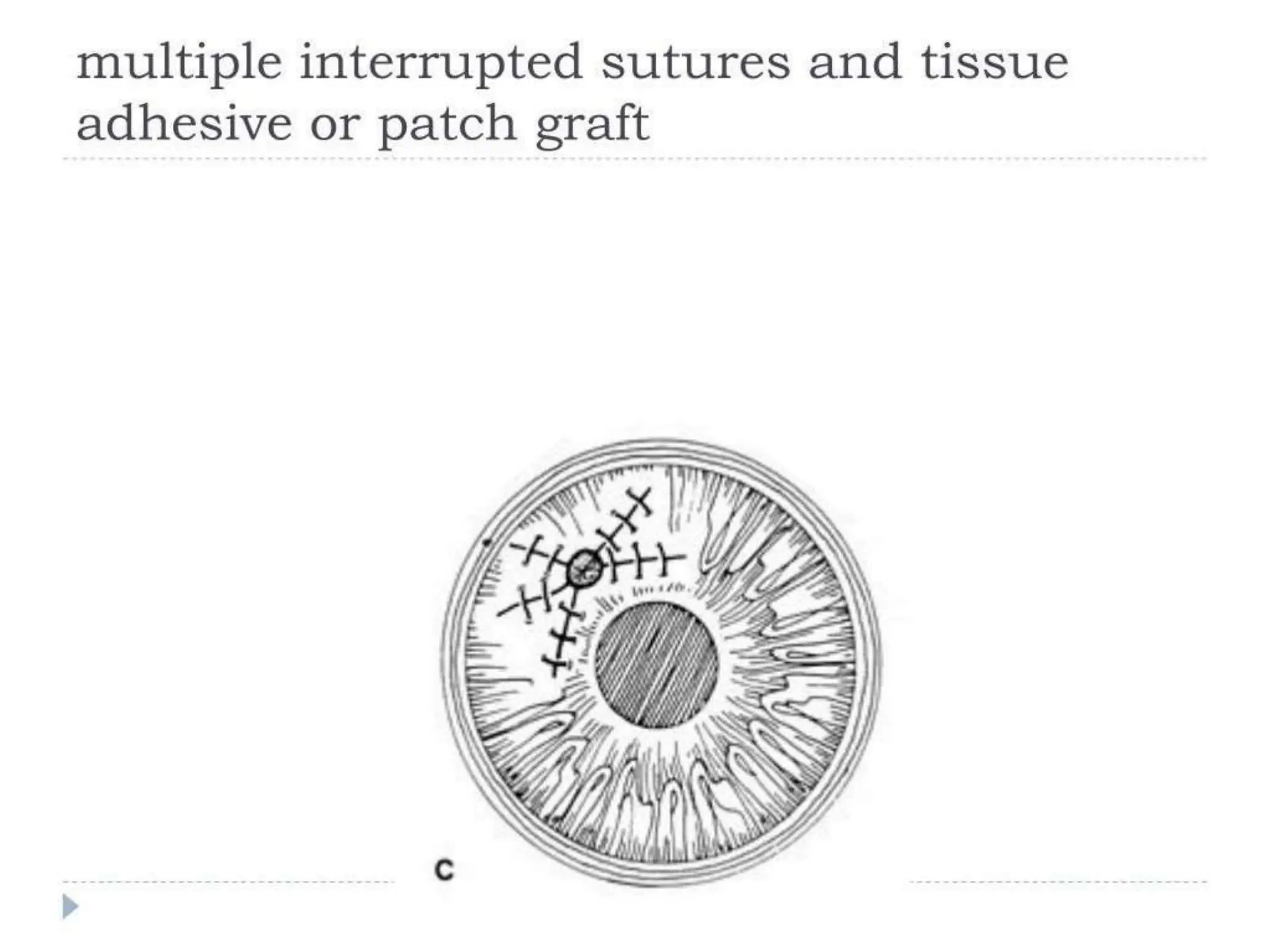 corneal l injury and laceration in eye.pptx