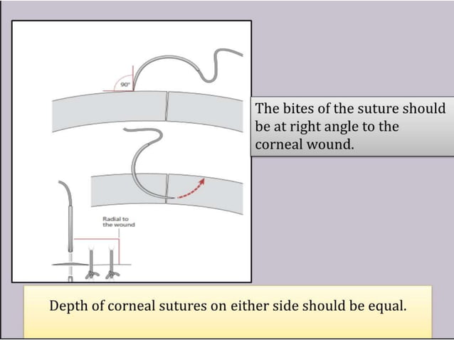 corneal l injury and laceration in eye.pptx