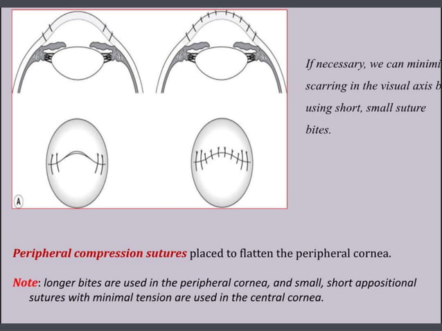 corneal l injury and laceration in eye.pptx