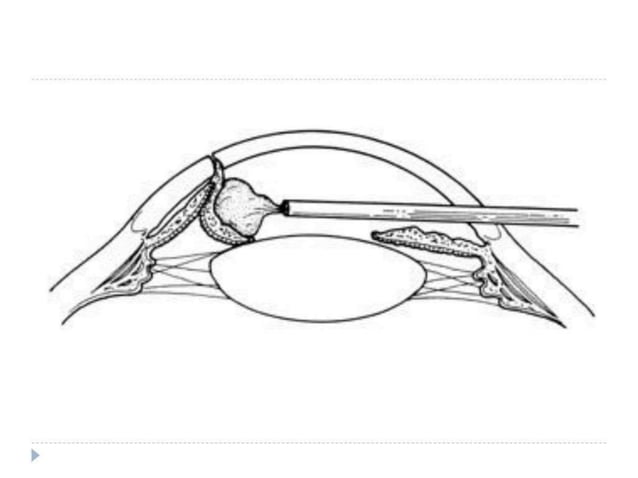 corneal l injury and laceration in eye.pptx