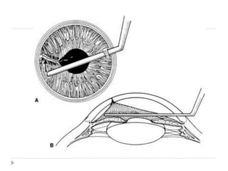 corneal l injury and laceration in eye.pptx