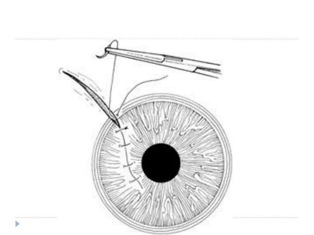corneal l injury and laceration in eye.pptx