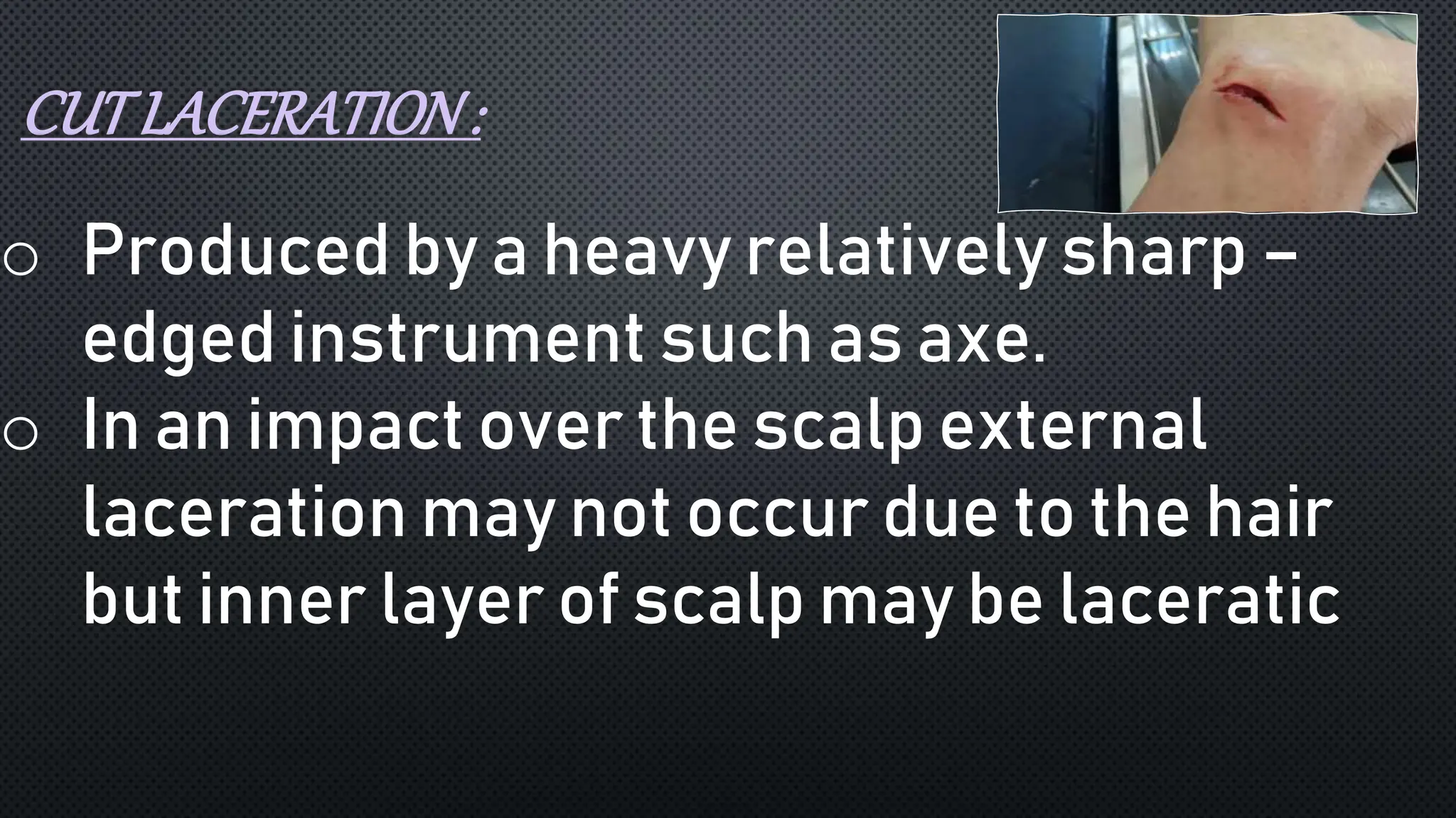 LACERATION INJURY | PPT | PPTX