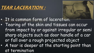 LACERATION INJURY | PPT | PPTX