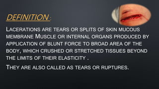 LACERATION INJURY | PPT | PPTX