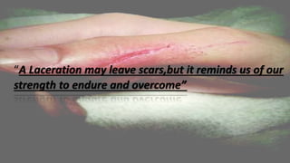 LACERATION INJURY | PPT | PPTX
