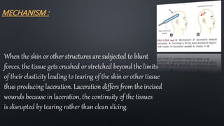 LACERATION INJURY | PPT | PPTX