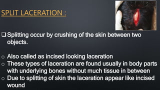 LACERATION INJURY | PPT | PPTX