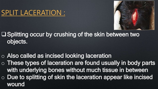 LACERATION INJURY | PPT | PPTX