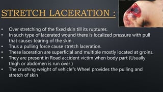 LACERATION INJURY | PPT | PPTX