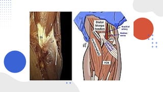 Lacertus Syndrome Lacertus Syndrome.pptx