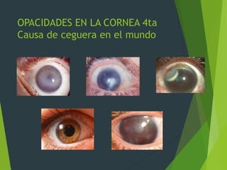 La cornea y sus alteraciones | PPTX