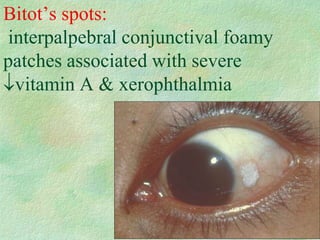 clinical evalaution of Lacrimal system for undergraduate | PPTX