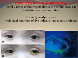 clinical evalaution of Lacrimal system for undergraduate | PPTX