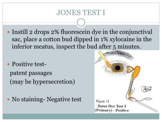 clinical evalaution of Lacrimal system for undergraduate | PPTX
