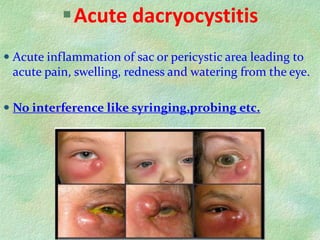 clinical evalaution of Lacrimal system for undergraduate | PPTX