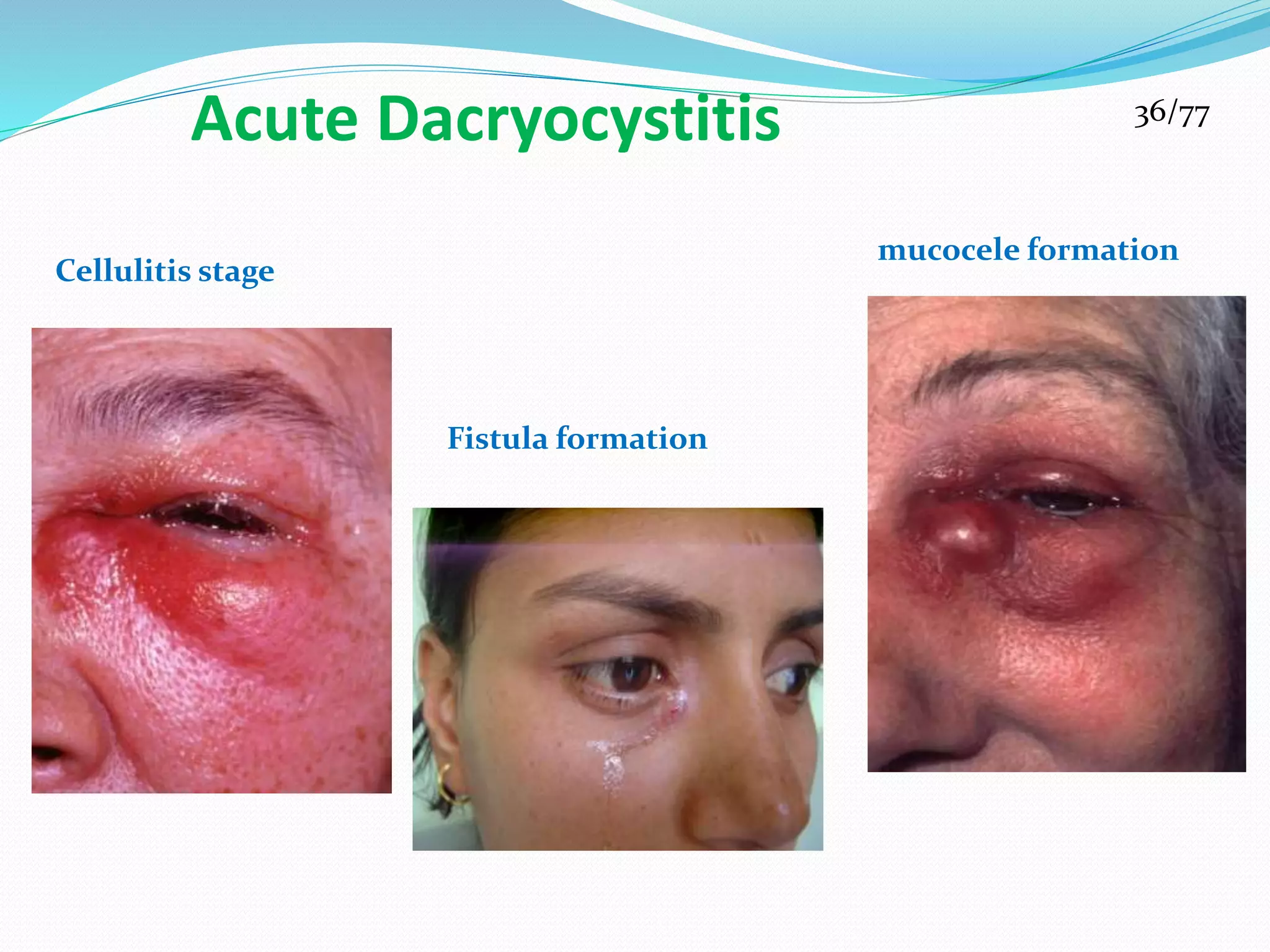 Lacrimal Apparatus: Different structure, Tear Film and Lacrimal Pump | PPTX