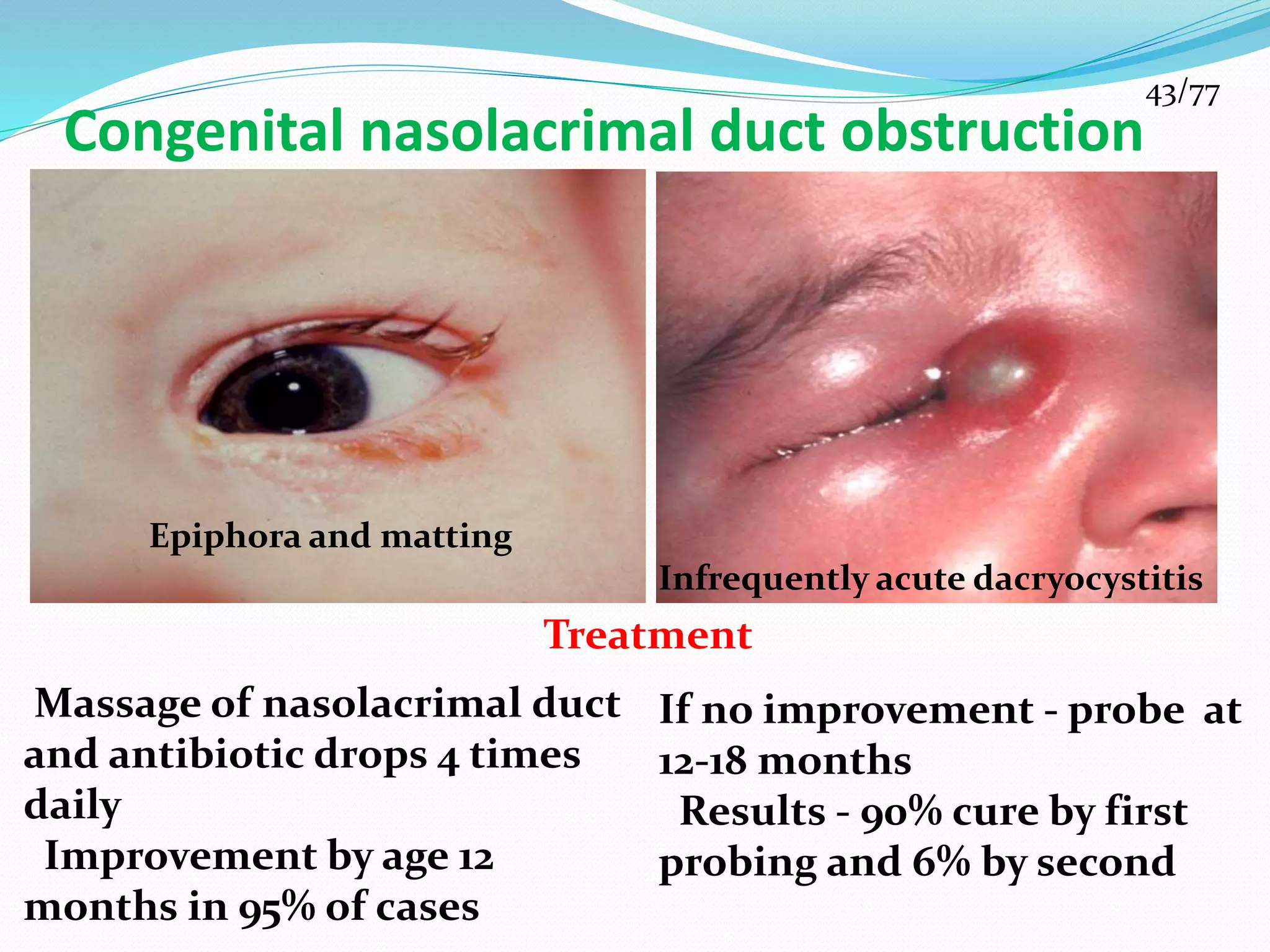 Lacrimal Apparatus: Different structure, Tear Film and Lacrimal Pump | PPTX