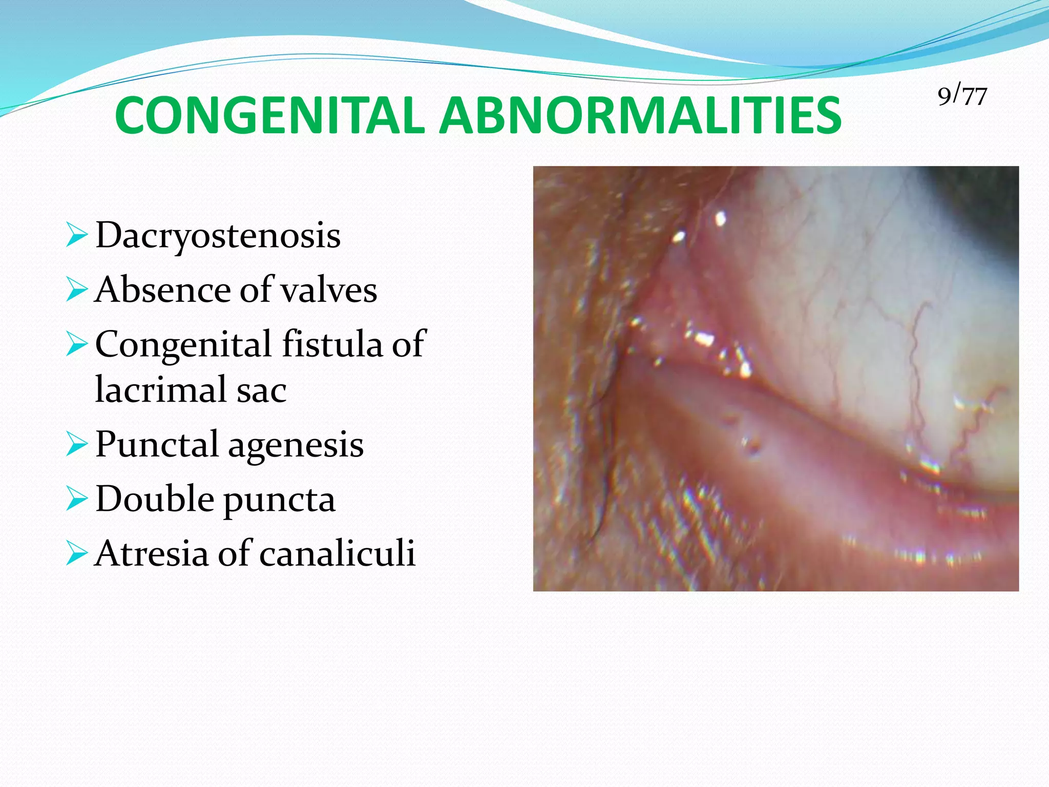 Lacrimal Apparatus: Different structure, Tear Film and Lacrimal Pump | PPTX