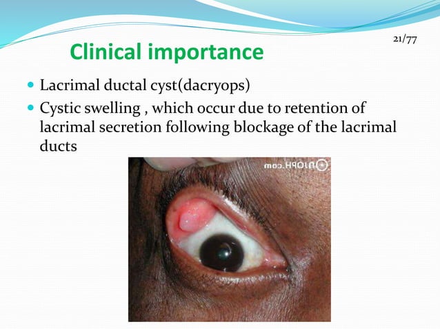 Lacrimal Apparatus: Different structure, Tear Film and Lacrimal Pump ...