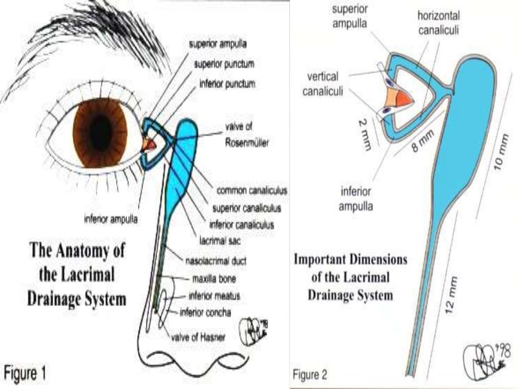 Lacrimal sac syringing