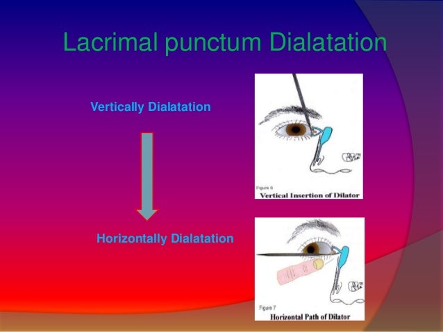 Lacrimal sac syringing