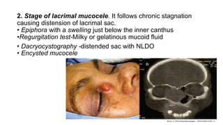 lacrimal apparatus.pptx
