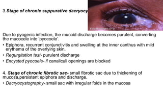 lacrimal apparatus.pptx